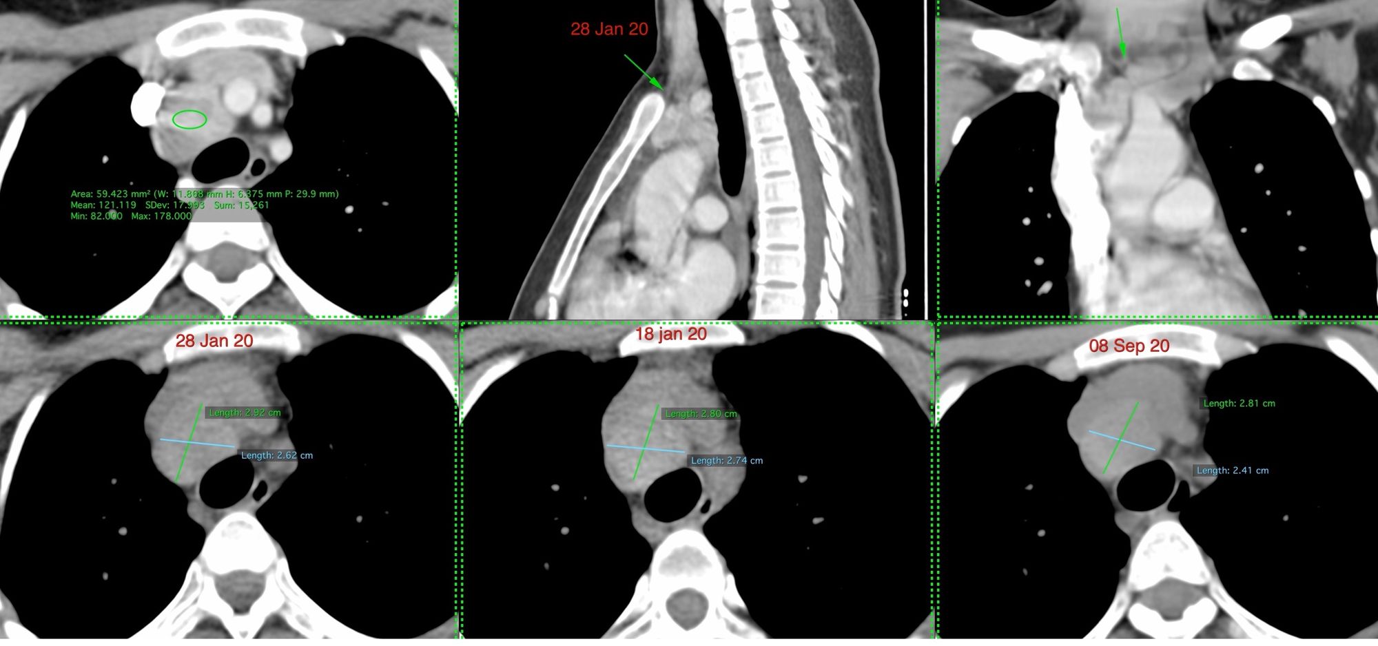Do Not Ignore the Non-Contrast (Plain) Study of a Chest CT Scan