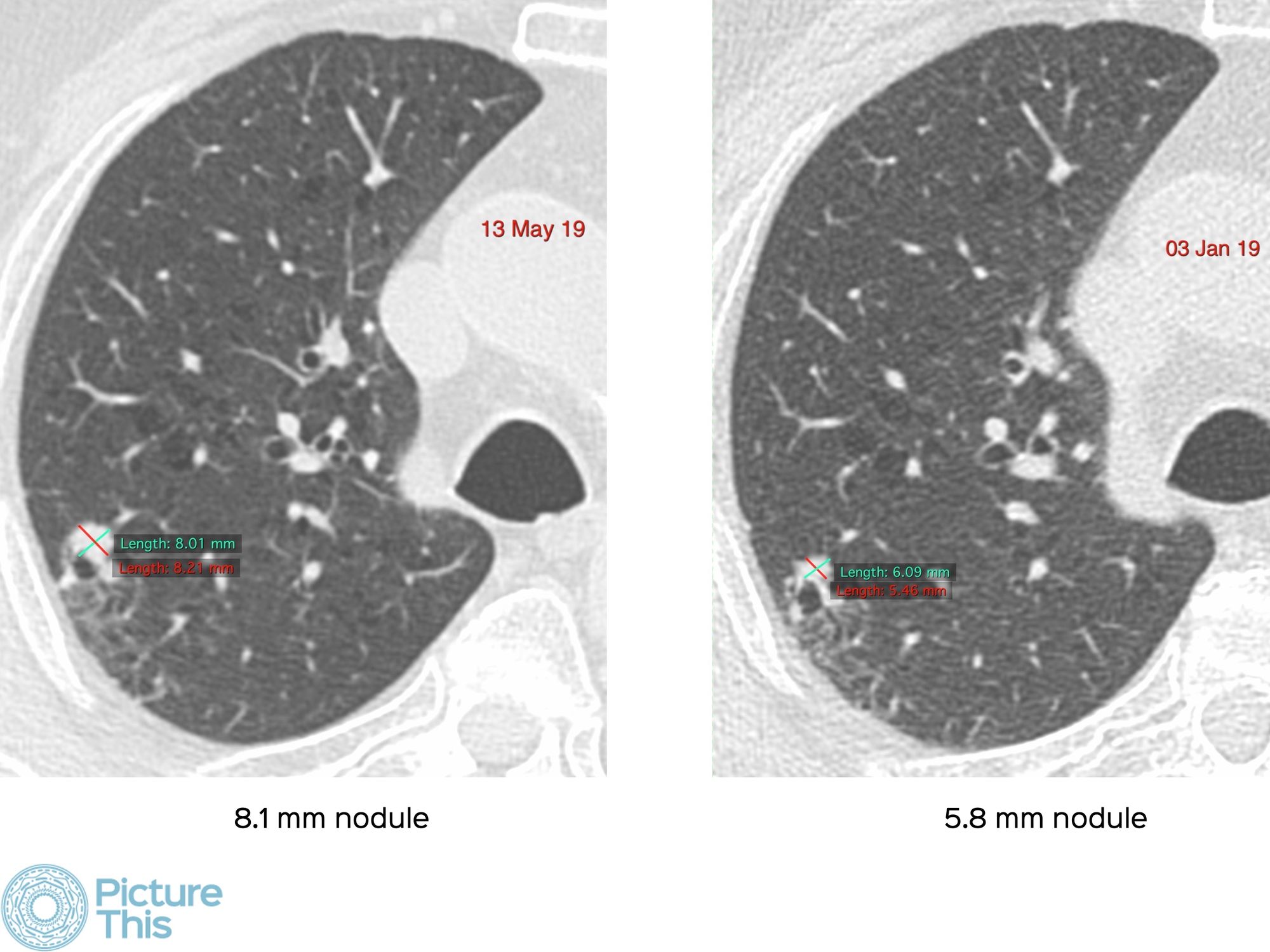 High Risk CT Imaging Features in Lung Cancer Screening