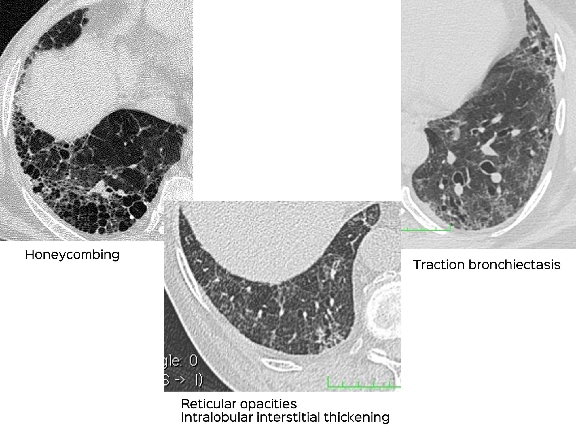 Interstitial Lung Disease Honeycombing