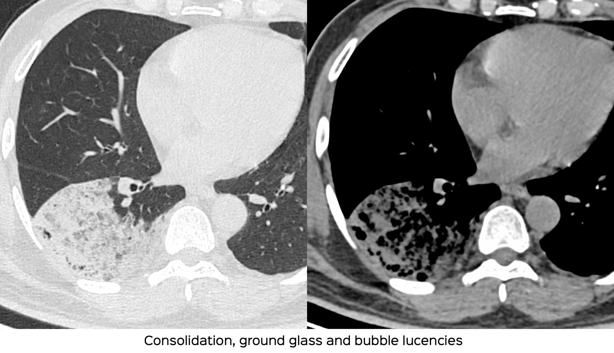 Case 9: Non-Resolving Consolidation and Multifocal Opacities