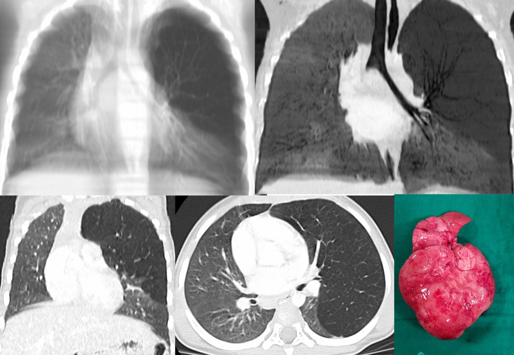 Case 13: Hyperlucent Hemithorax in a 3-Years Old
