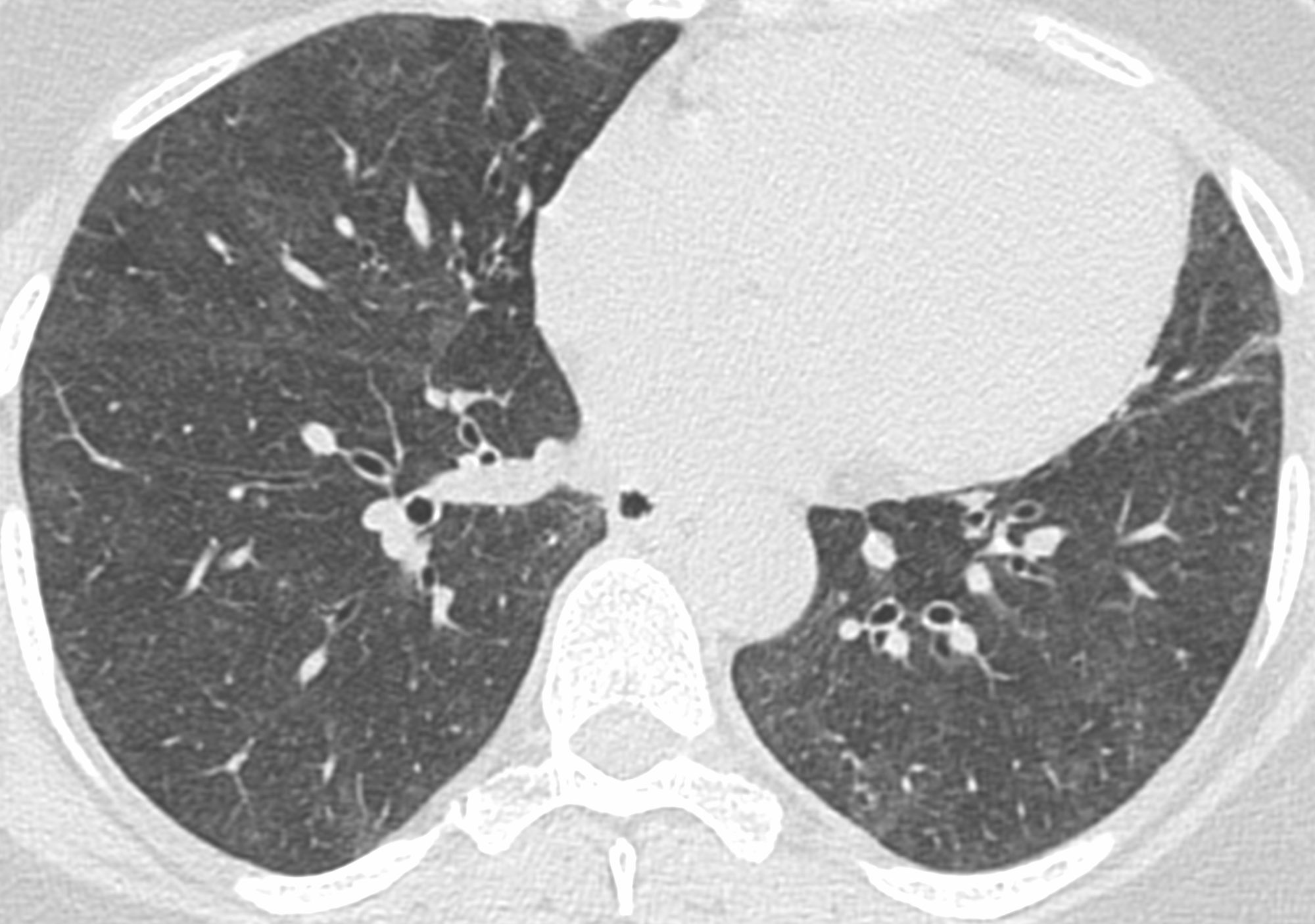Case 16: 56 years old with fever, breathlessness and ground glass on CT