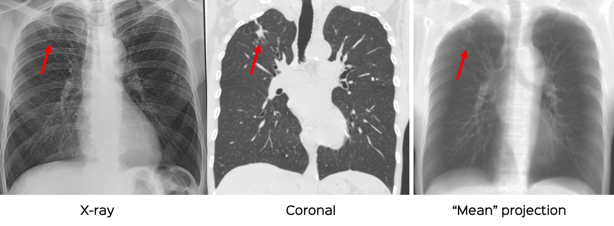 Case 23: Simulating a Chest X-ray on CT Scan To Compare with Prior X ...