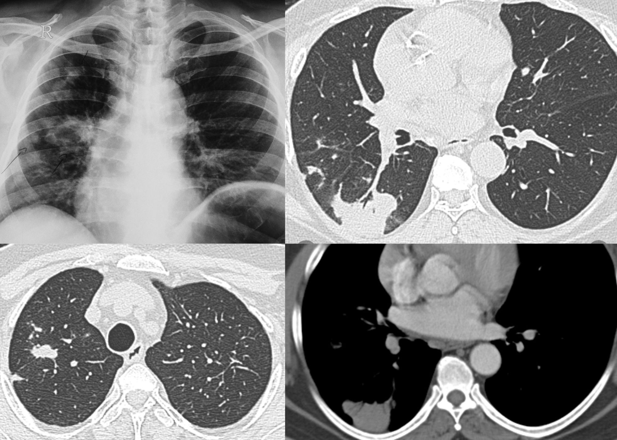 Illustration Of Lung Ct Image Infection Lung Lobes An - vrogue.co Illustration Of Lung Ct Image Infection Lung Lobes An - vrogue.co