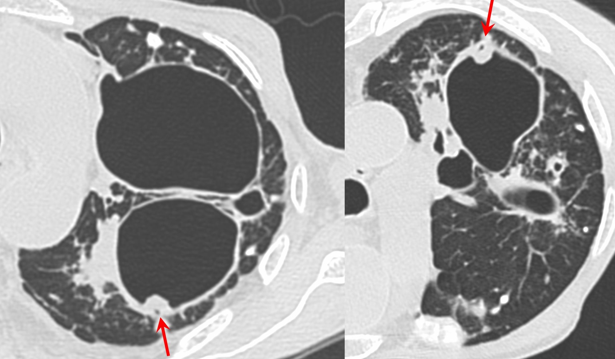 Case 20: "Scab-Like" Sign for Chronic Cavitary Aspergillosis