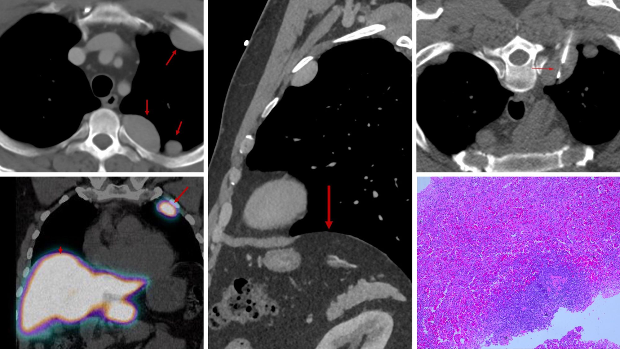 Case 25: 45-Years Old Man with Extrapleural Masses