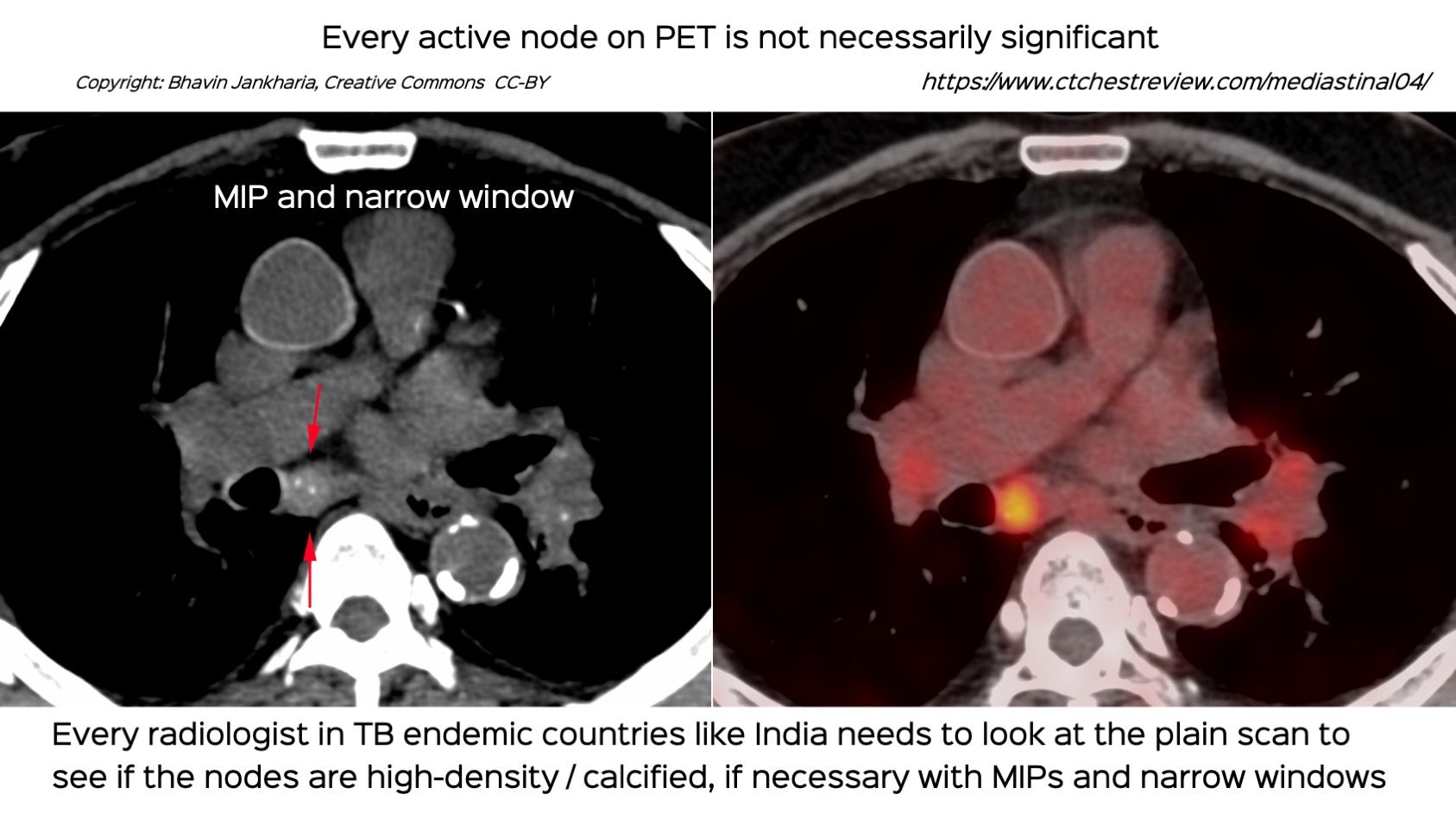 Calcification Of Lymph Nodes