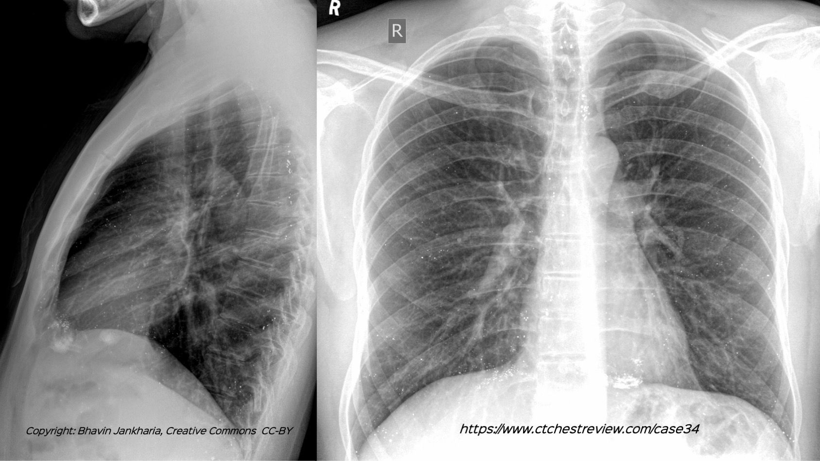Case 34 All High Density Foci In The Lungs Are Not Old Calcified