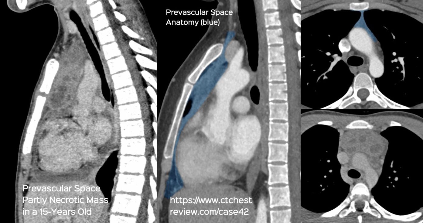 Case 42: Every Necrotic Mass in the Prevascular Space of the ...