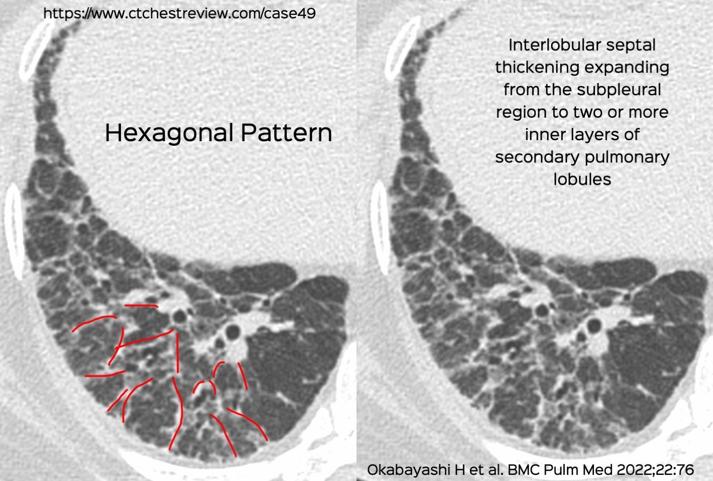 Case 49: The Hexagonal Pattern in Fibrotic Hypersensitivity Pneumonitis