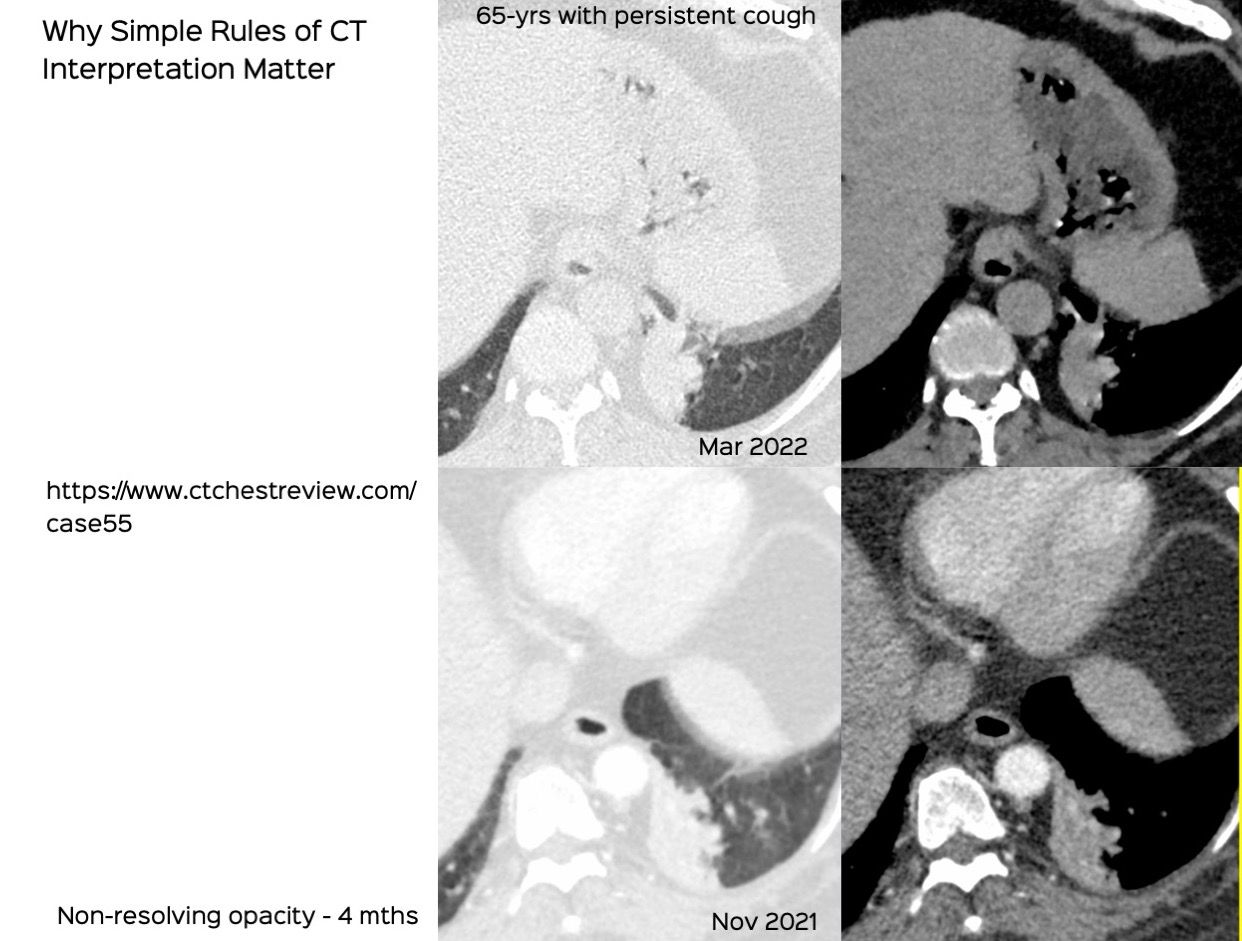 Case 55: Why Simple Rules of CT Interpretation Matter