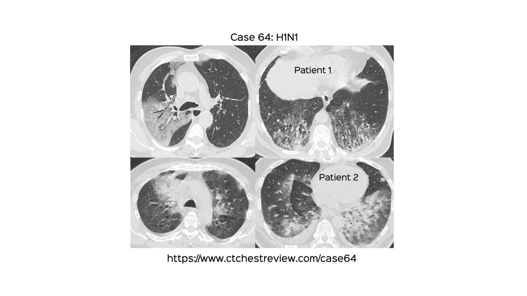 Case 64: Diagnosing H1N1 Lung Involvement