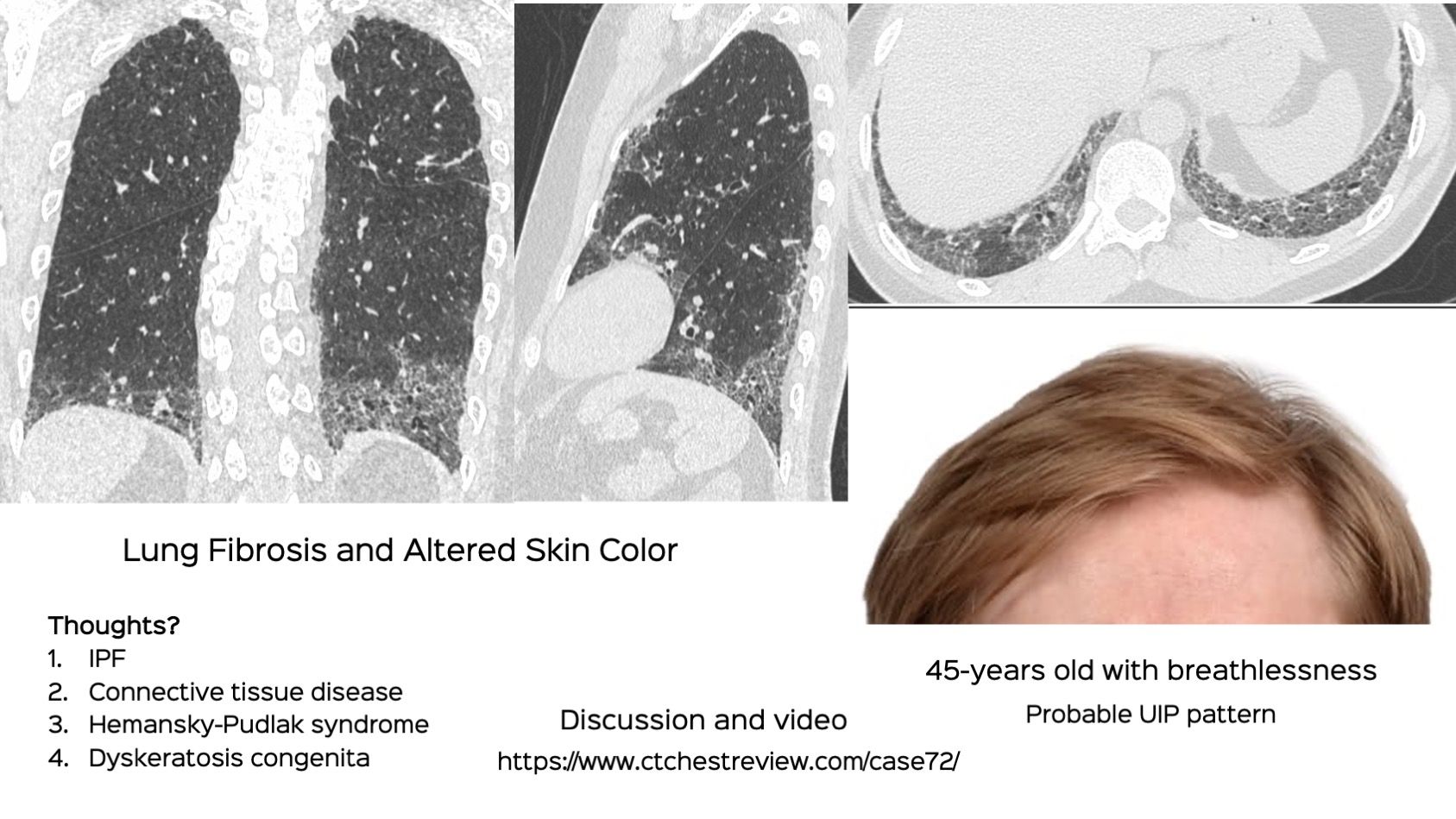 Case 72: Lung Fibrosis and Altered Skin Color