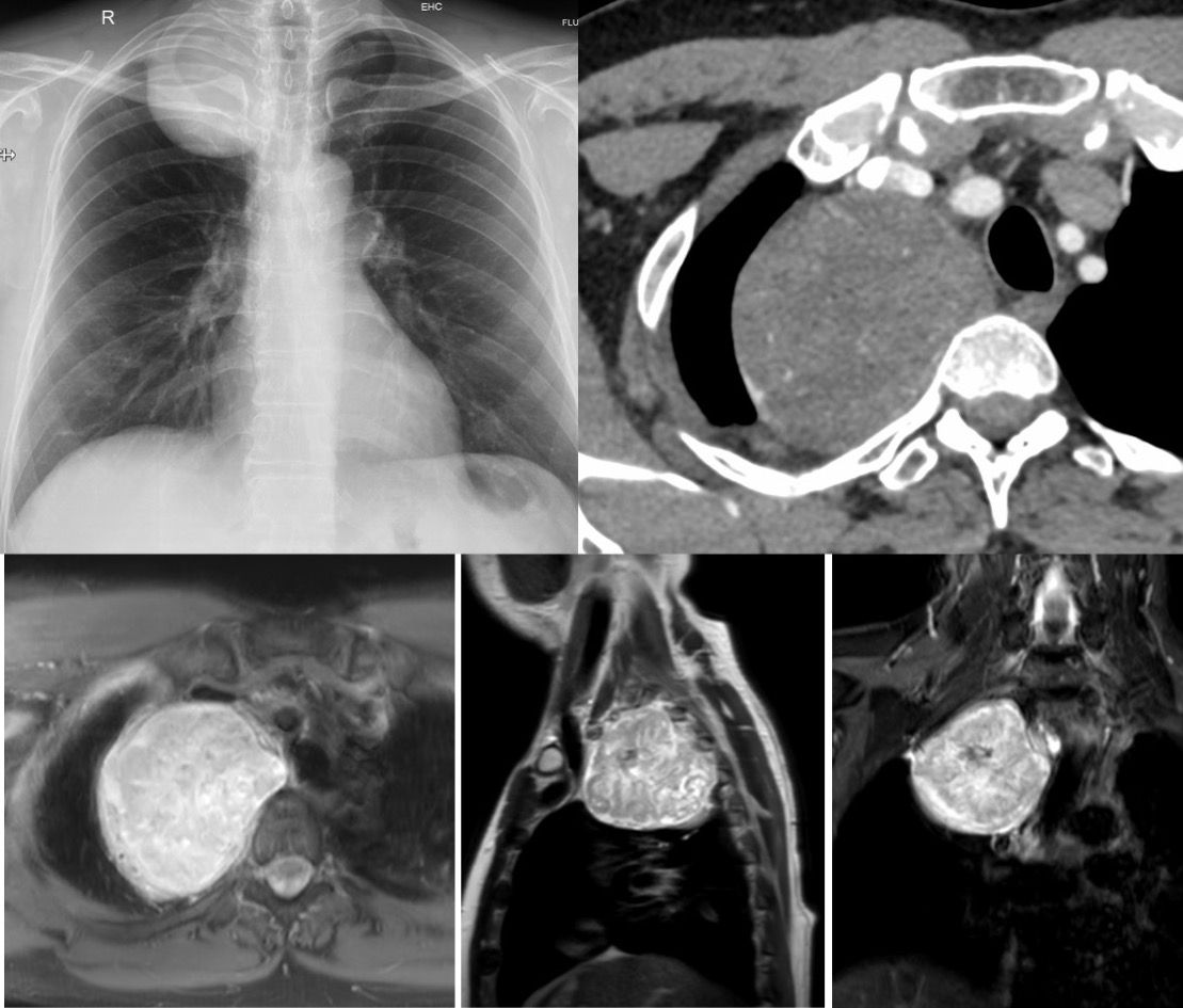 Case 80: Upper Posterior Paravertebral Mass