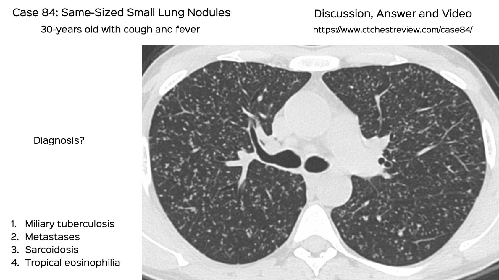 Case 84 Same Sized Small Lung Nodules