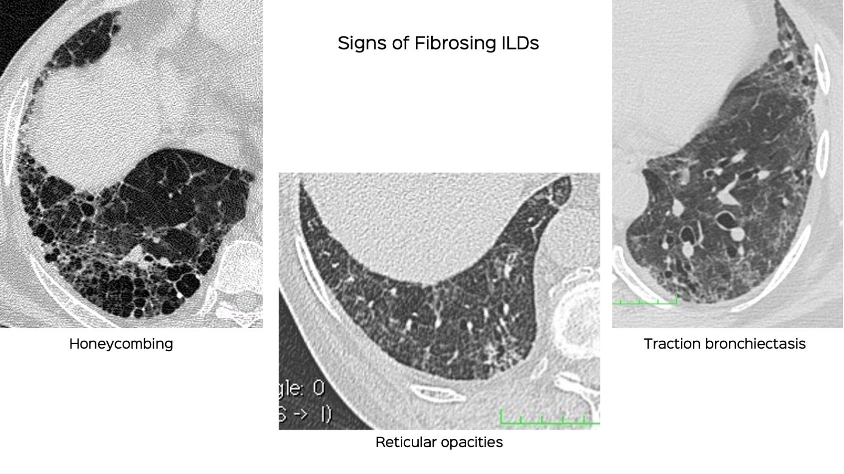 REF-Cafe Roentgen Thoracic Thursday Lecture - I: Fibrosing ILDs - 2023 ...