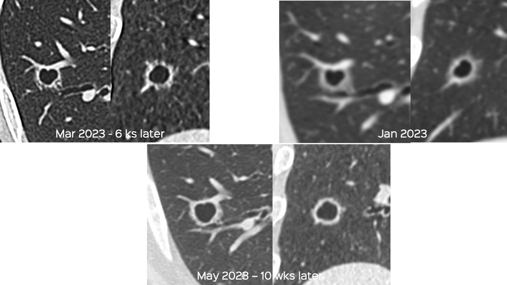 Case 86: A Growing Cavitated Nodule