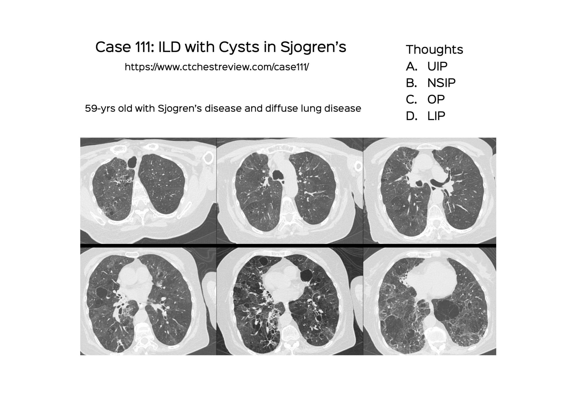 Case 111: ILD with Cysts in Sjogren's