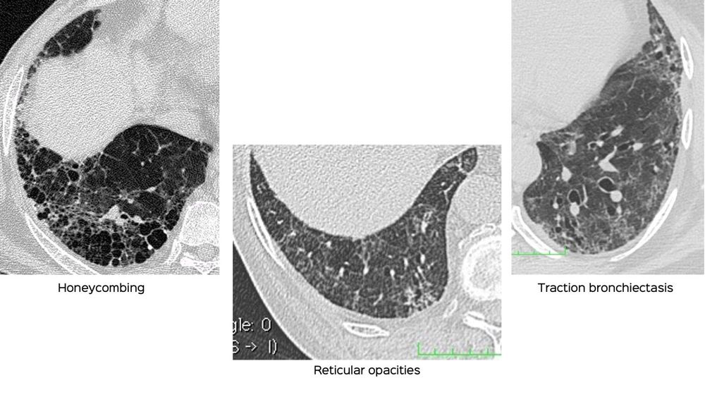 Lecture: Fibrosing ILDs - Understanding Reticular Opacities, Traction ...
