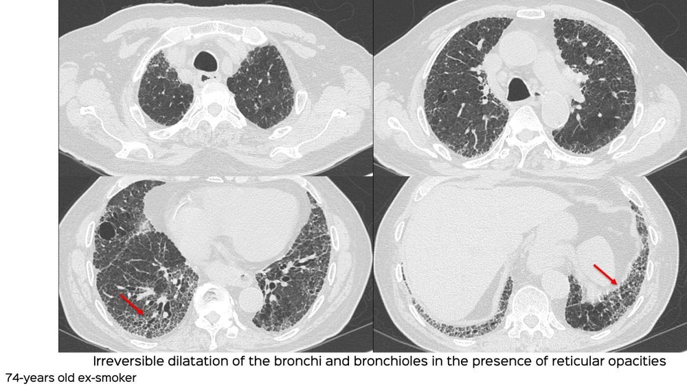 Lecture: Fibrosing ILDs - Understanding Reticular Opacities, Traction ...
