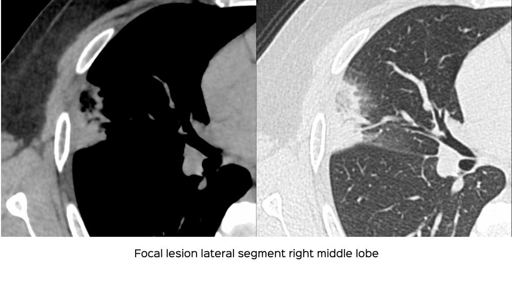 Case 91: Bubble Lucencies, Central Lucencies, Bubbly Consolidation
