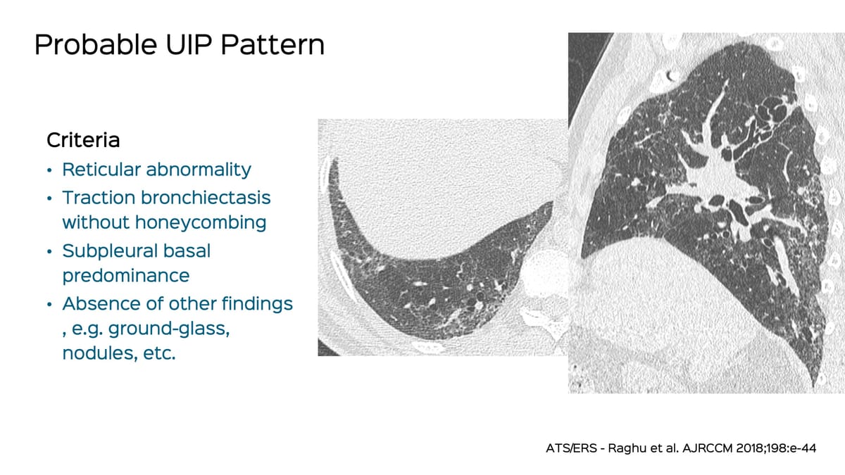 Case 6: Probable Usual Interstitial Pneumonia (Probable UIP) - IPF