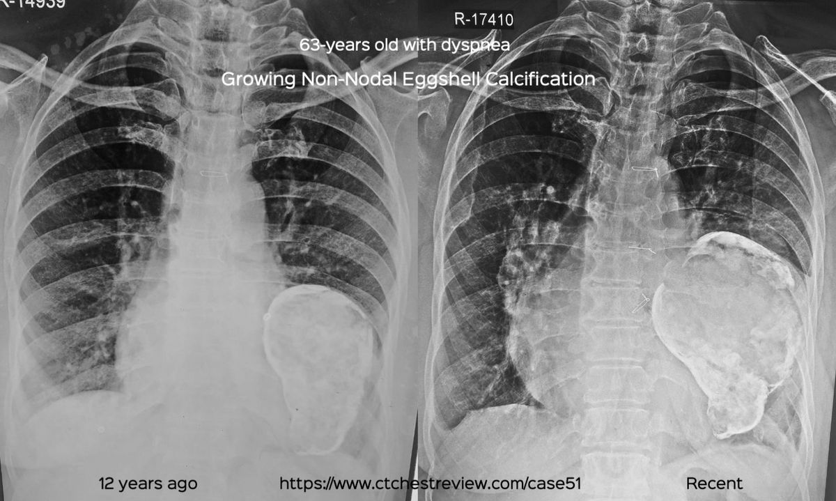 Case 51: Growing Thoracic Non-Nodal Eggshell Calcification
