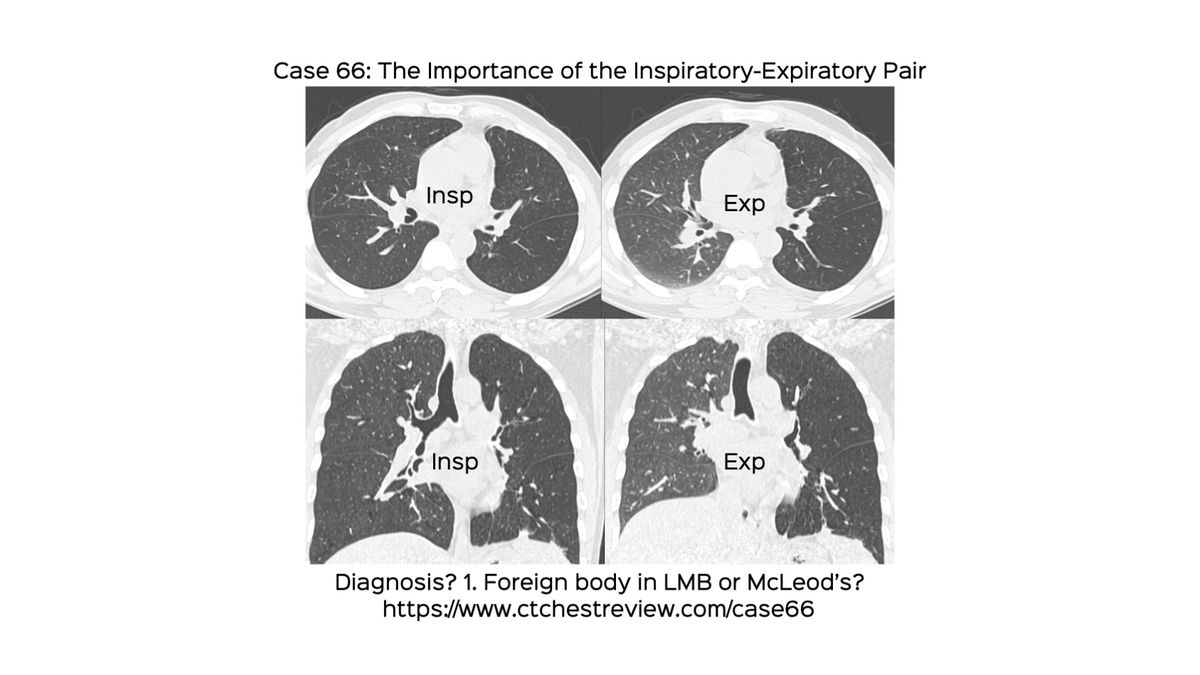 Case 66: The Importance of the Inspiratory-Expiratory Pair