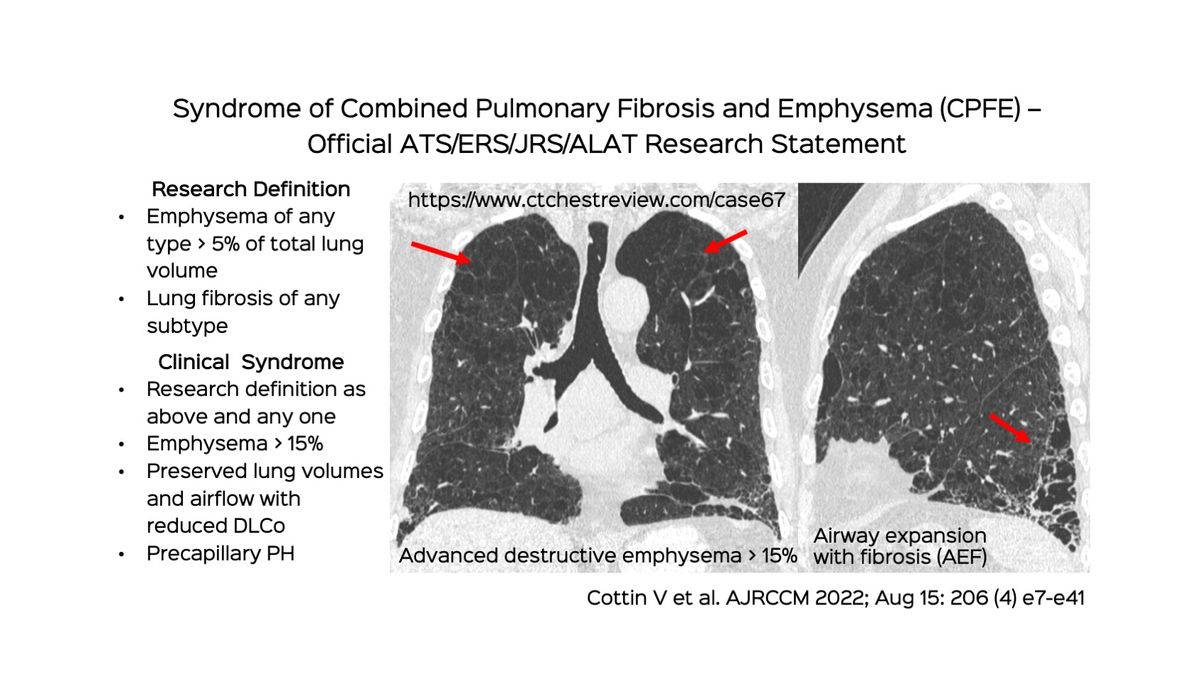 Case 67: Syndrome of Combined Pulmonary Fibrosis and Emphysema (CPFE ...