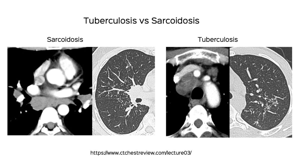 Tuberculosis vs Sarcoidosis - Lecture