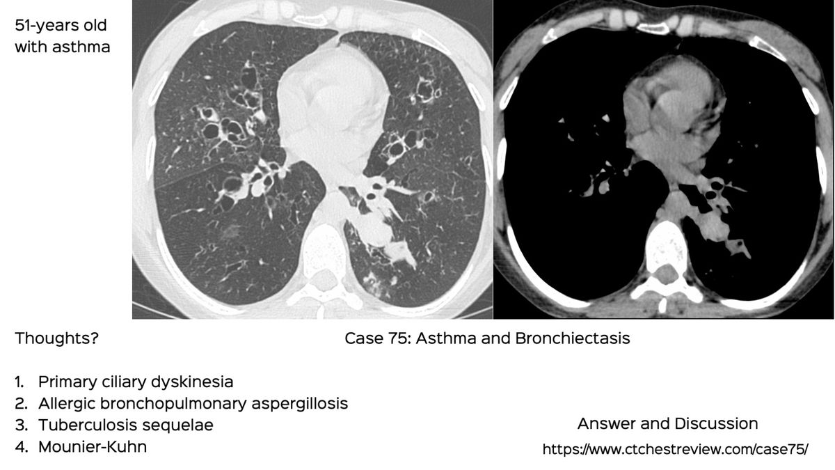 Case 75: Asthma and Bronchiectasis