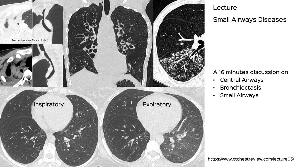 Lecture 05: Airways Diseases