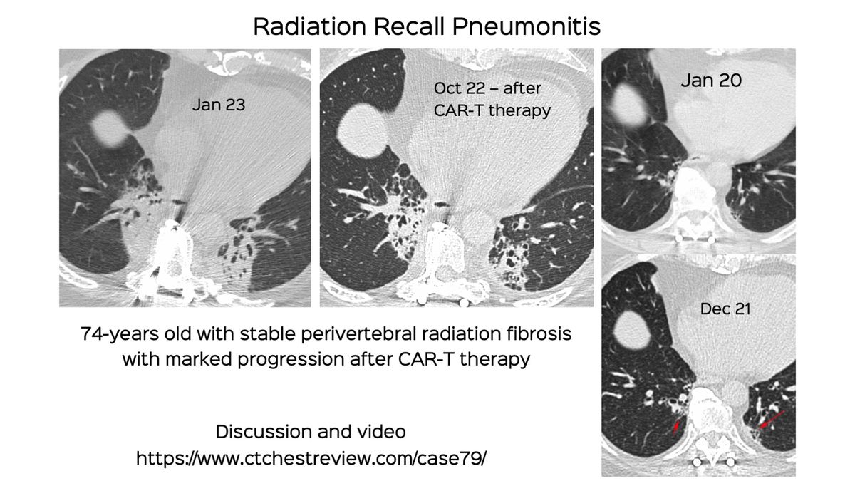 Case 79 New Progression Of Perivertebral Radiation Fibrosis