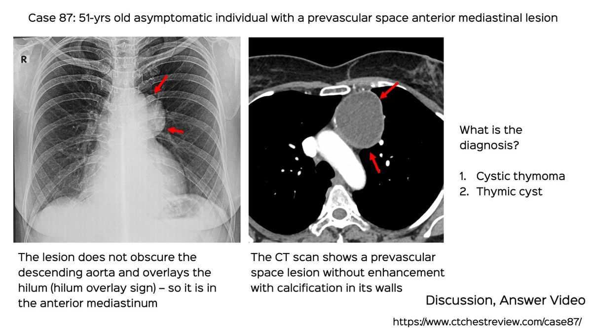 Mediastinal Ct Images Of Cysts