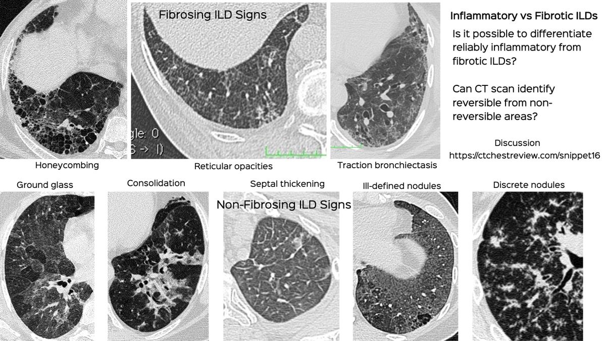 Snippet 16: Inflammatory vs Fibrotic ILD