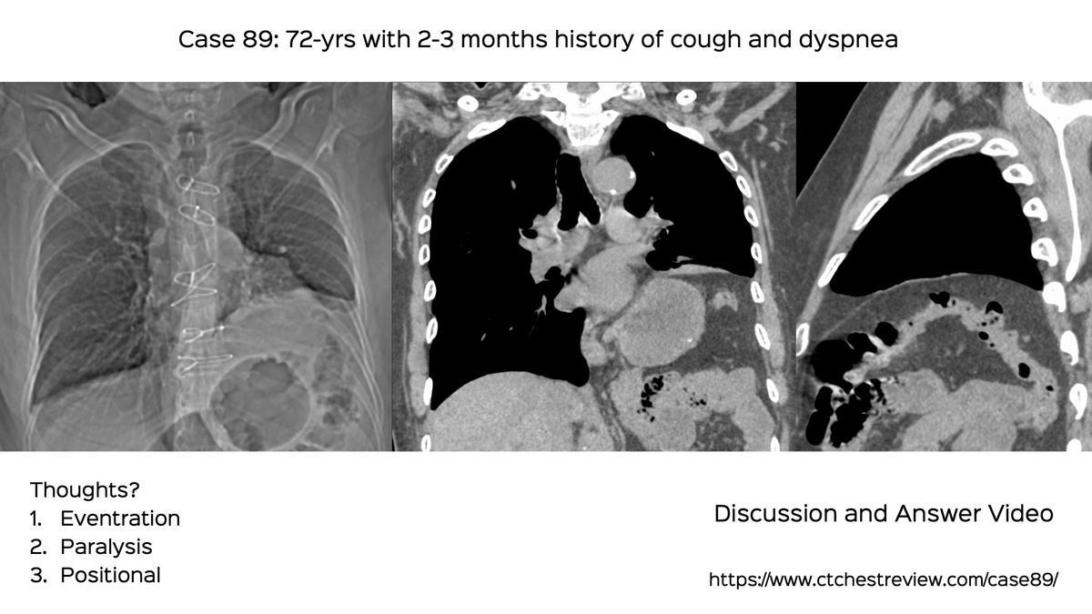 Case 89: Diaphragmatic Dysfunction – Eventration, Paralysis…Does it Matter