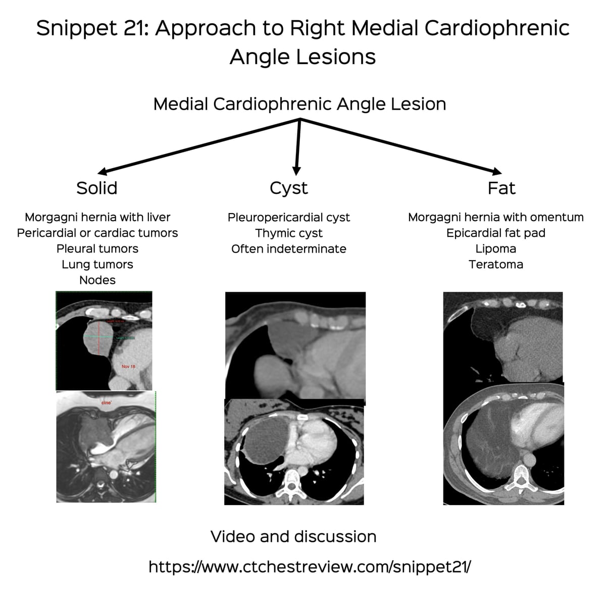 Snippet 21: Approach to Right Medial Cardiophrenic Angle Lesions