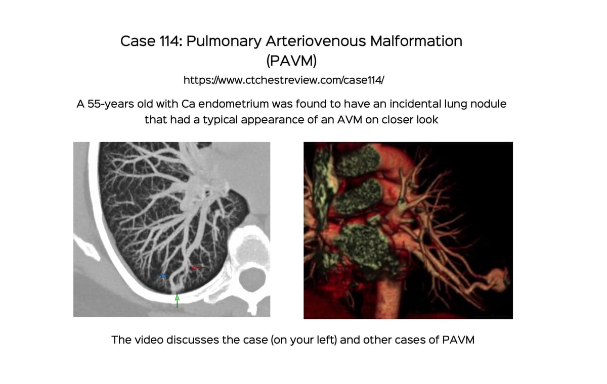 Case 114: Pulmonary Arteriovenous Malformation (PAVM)