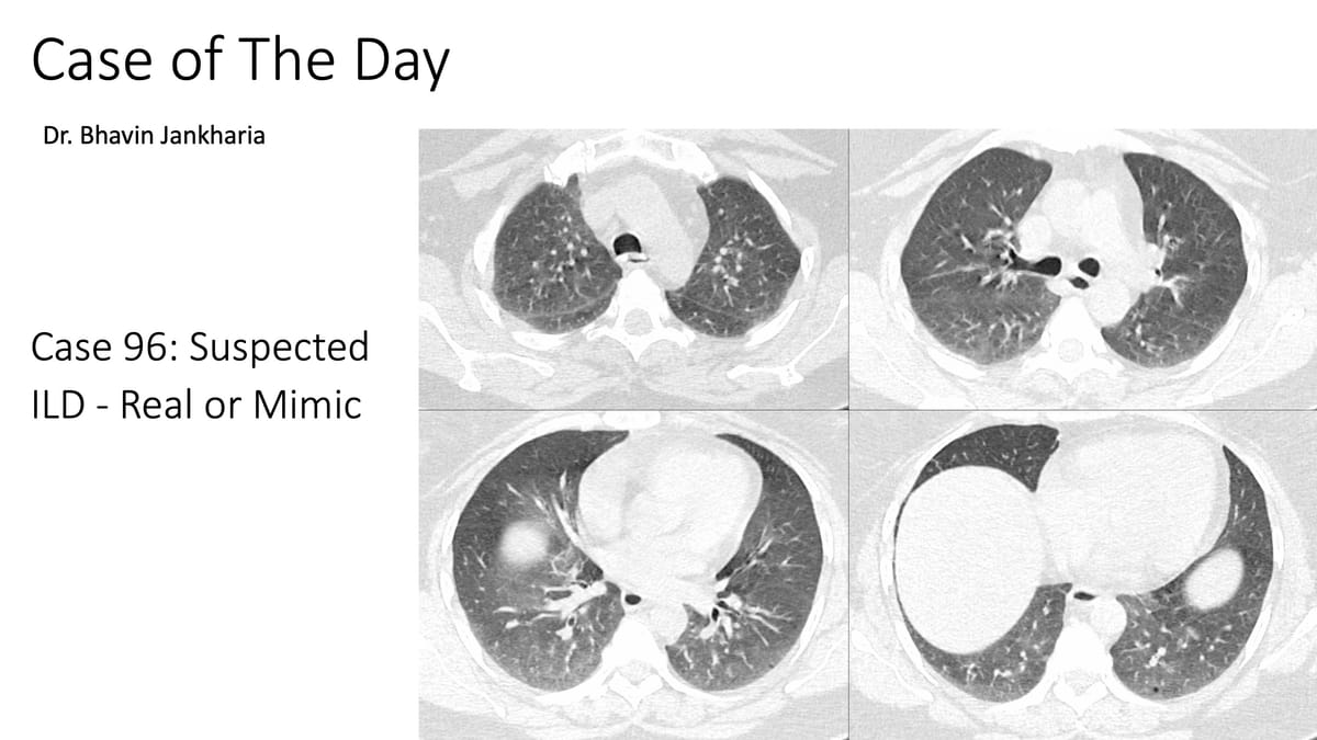 Case of the Day 096 - Suspected ILD - Real or Mimic?