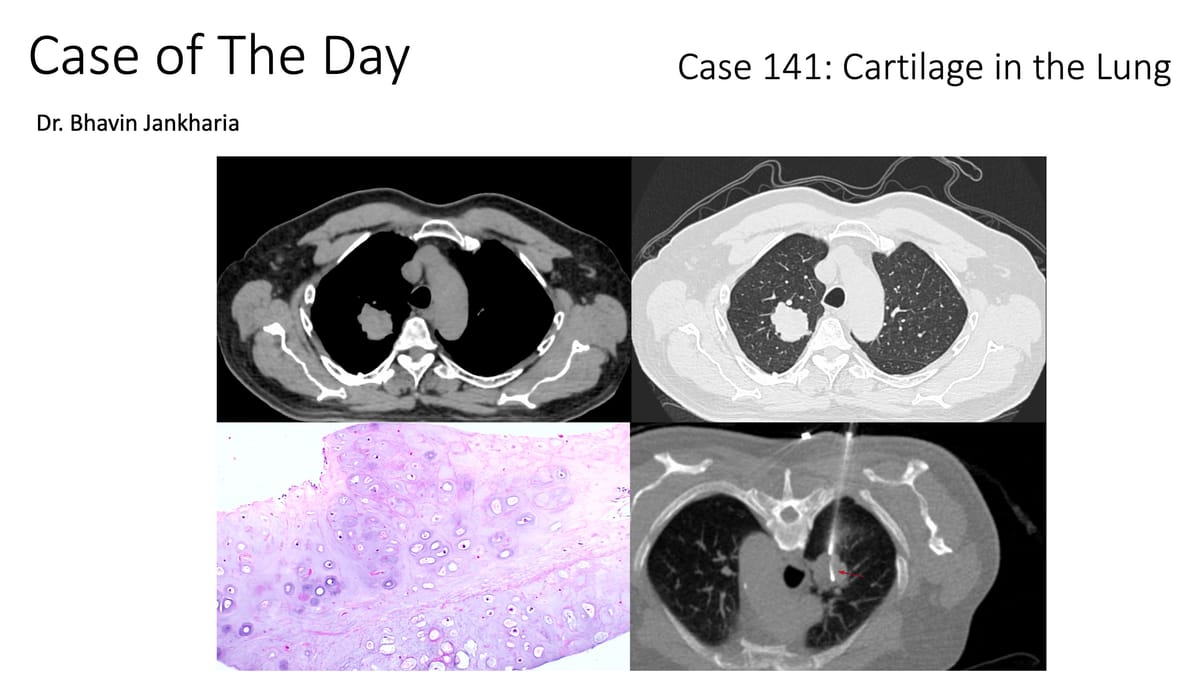 COD 141 - Cartilage in the Lung