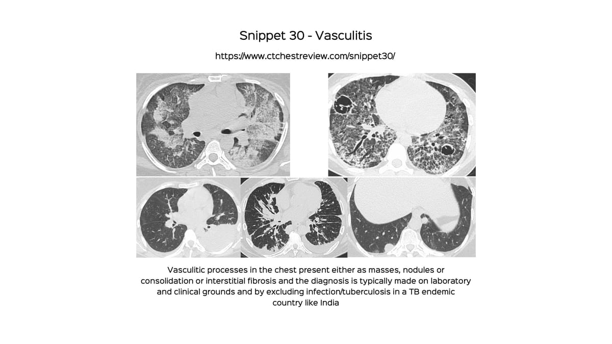 Snippet 30 - Vasculitis