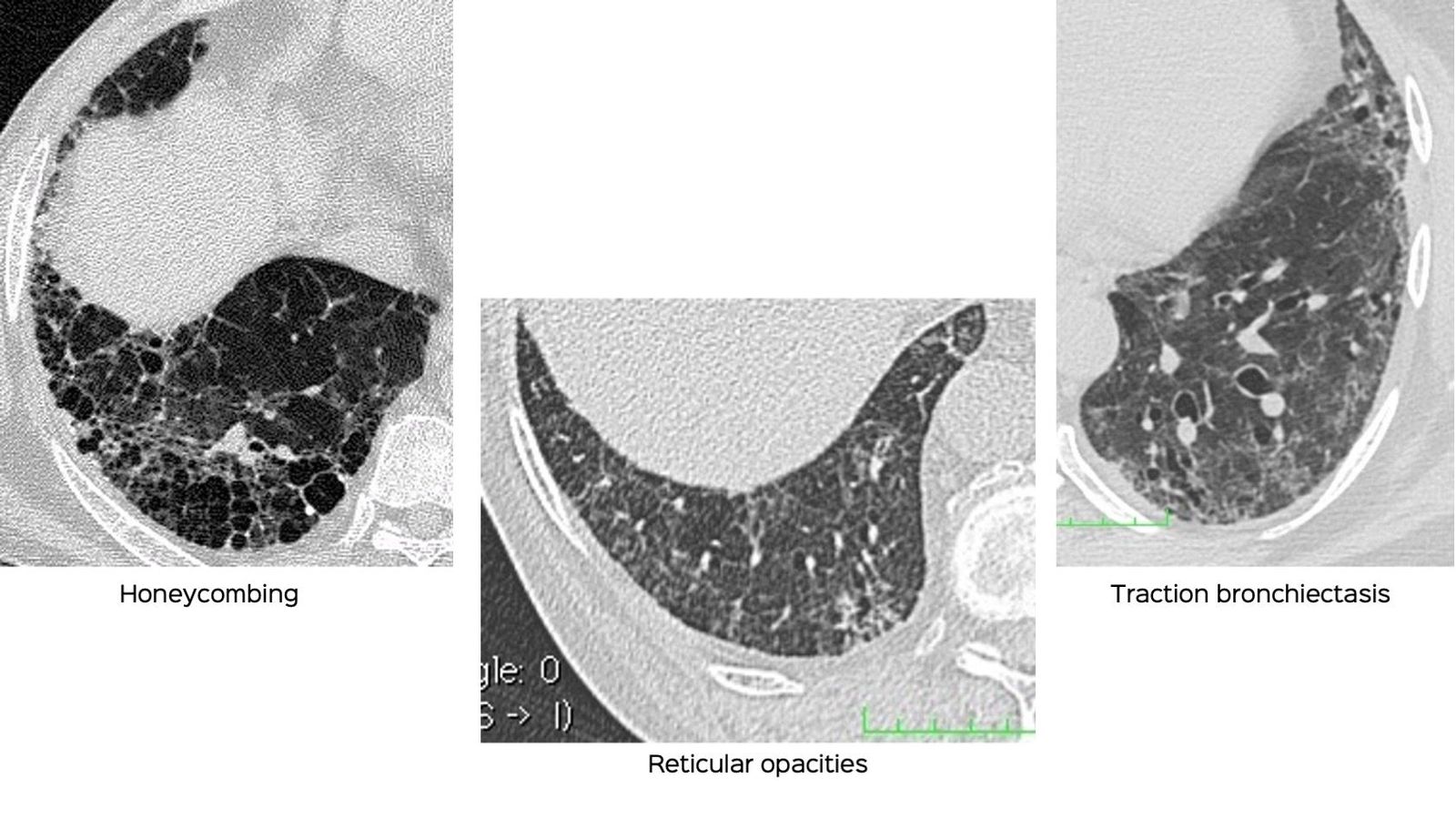 Lecture: Fibrosing ILDs - Understanding Reticular Opacities, Traction ...
