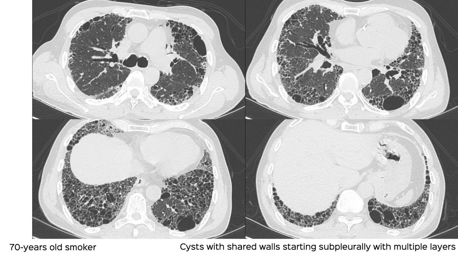Lecture: Fibrosing ILDs - Understanding Reticular Opacities, Traction ...