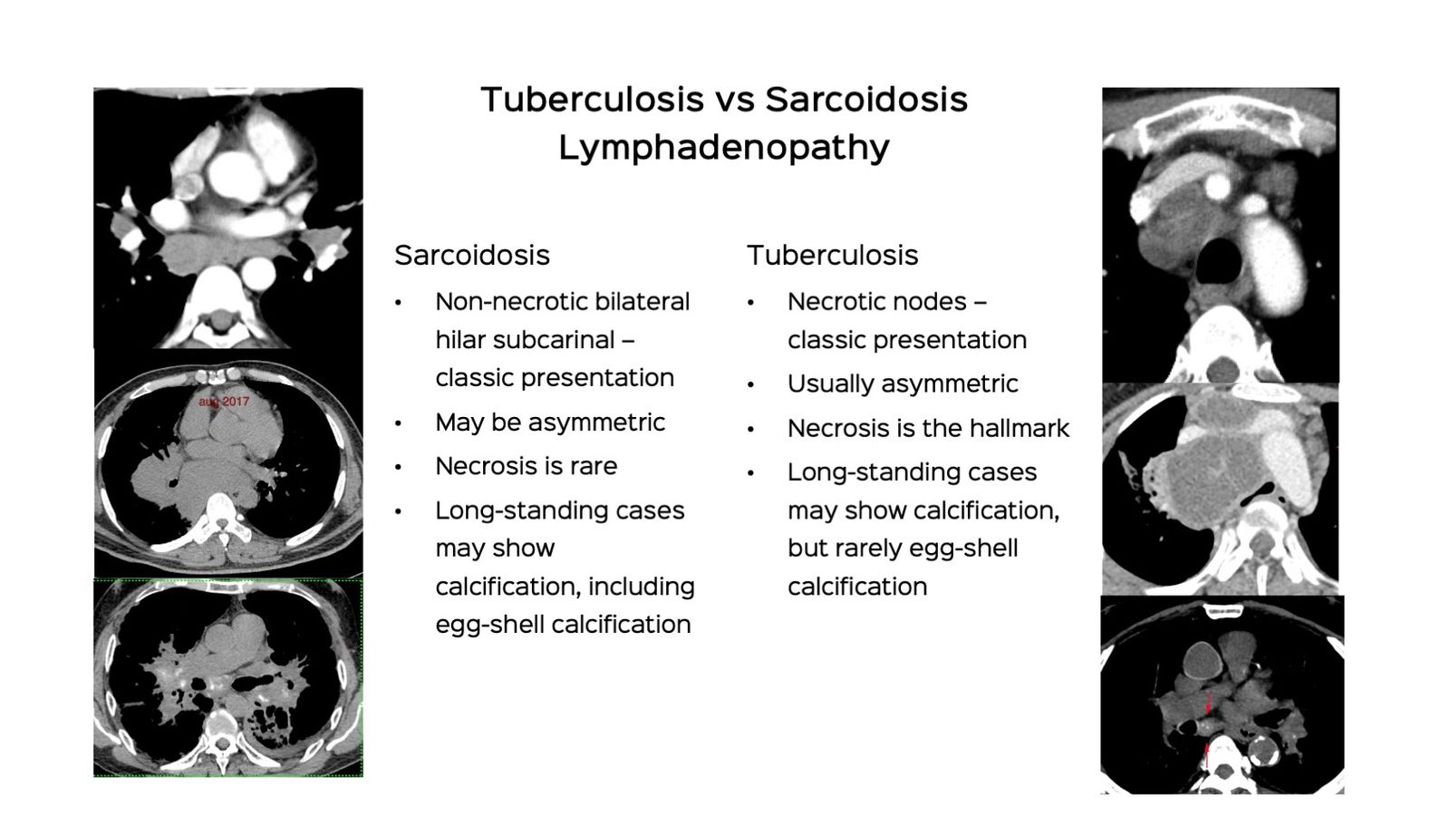 Tuberculosis vs Sarcoidosis - Lecture