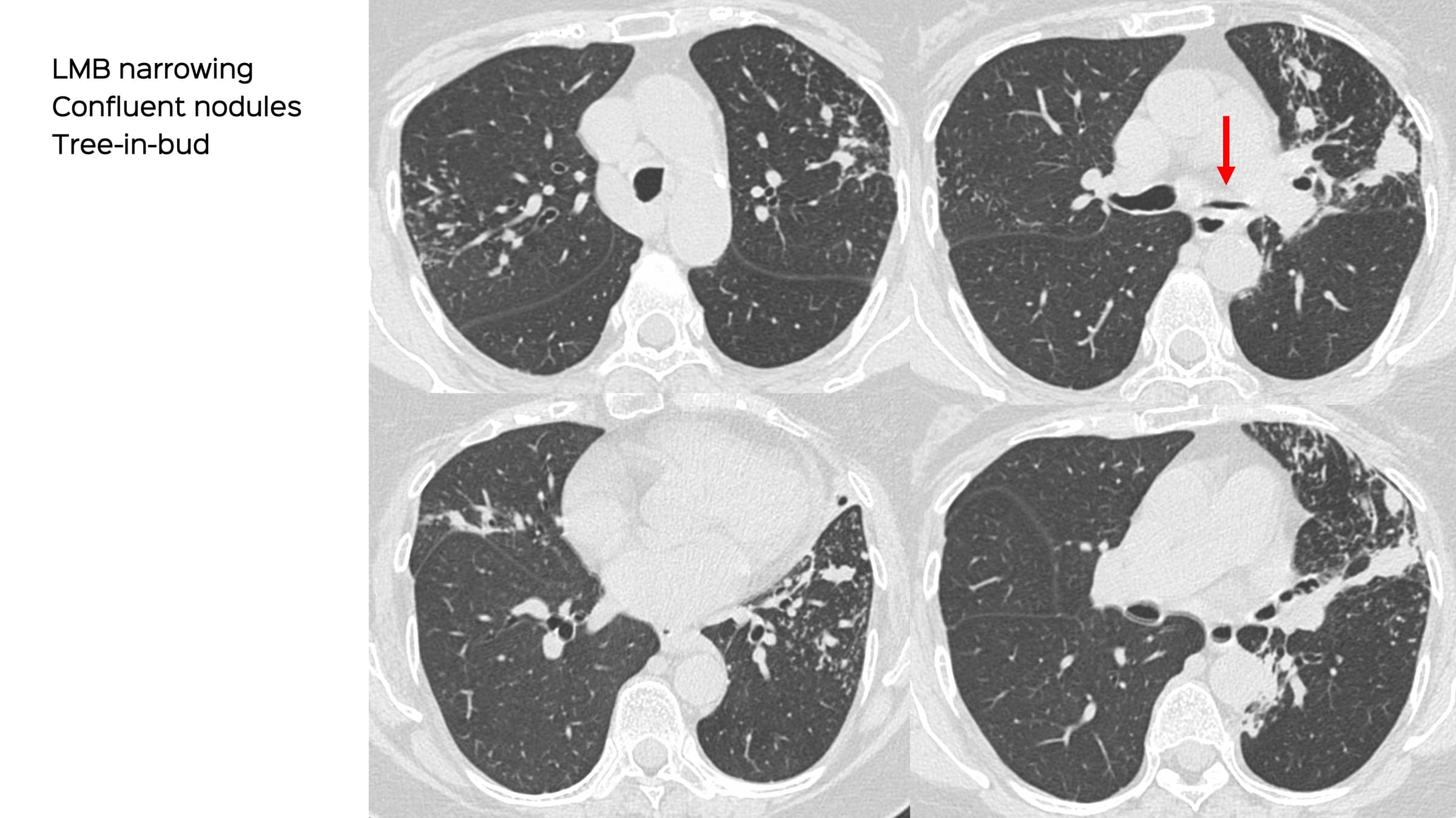 Case 102: Tracheobronchial Tuberculosis