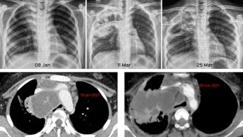 Tuberculosis - CT Chest Review