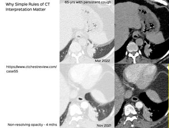 Non-Resolving Consolidation - CT Chest Review