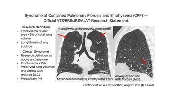Snippet 12: Visual Classification of Centrilobular and Paraseptal Emphysema