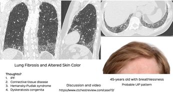 Case 72: Lung Fibrosis and Altered Skin Color