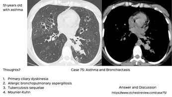 Bronchiectasis - CT Chest Review